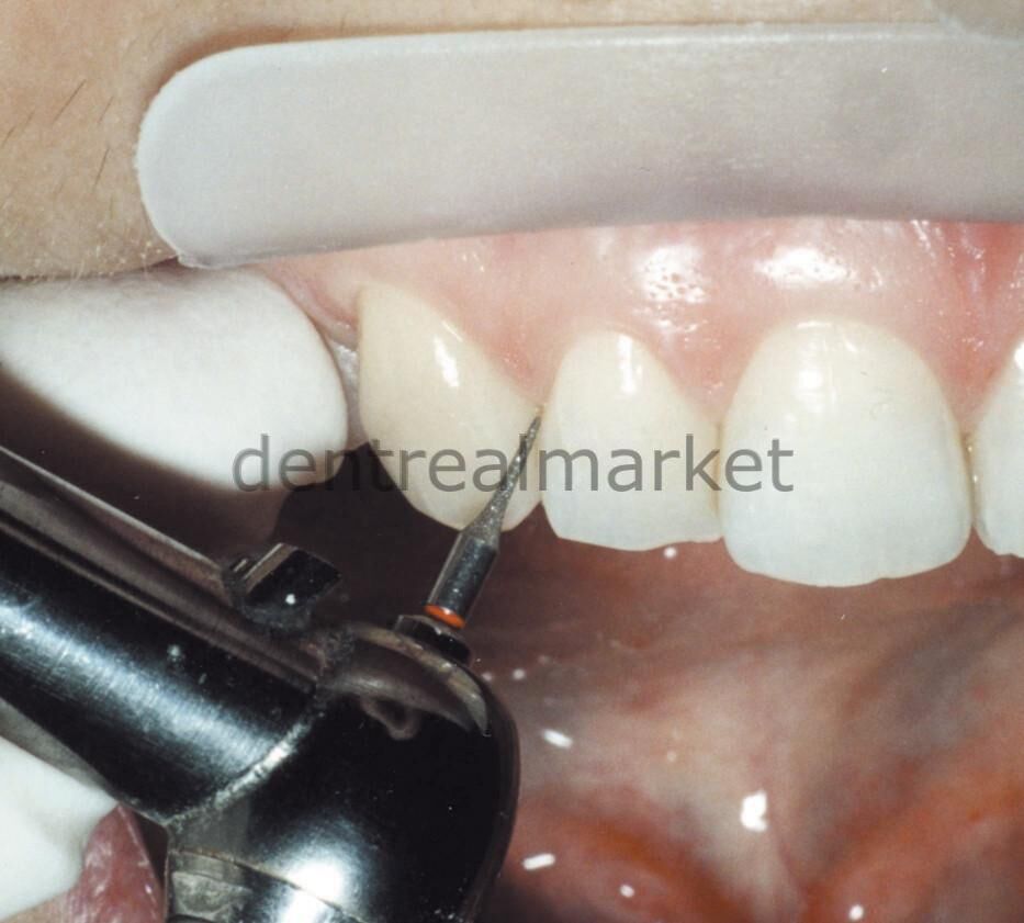 Orthodontik IPR Frezi 392L - Interproximal Frez | Frank Dental