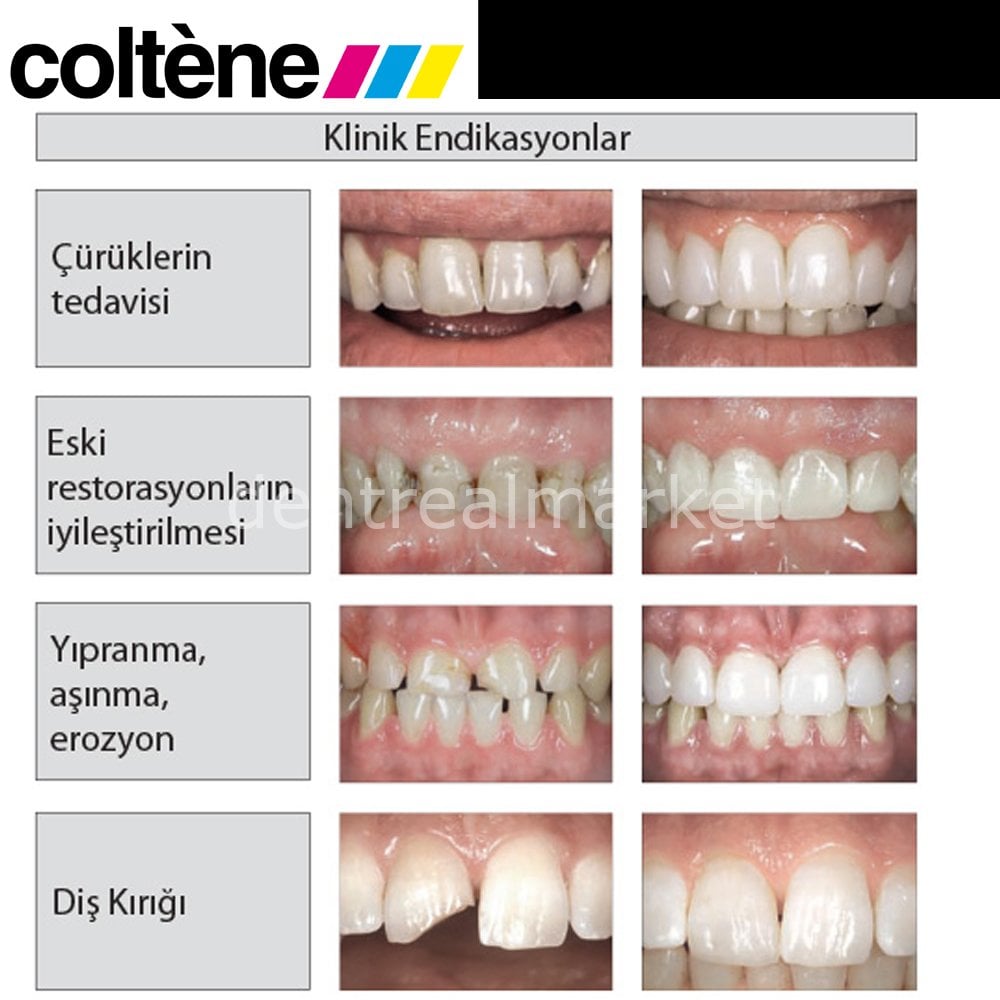 Componeer Kompozit Veneer Mini Set | Coltene