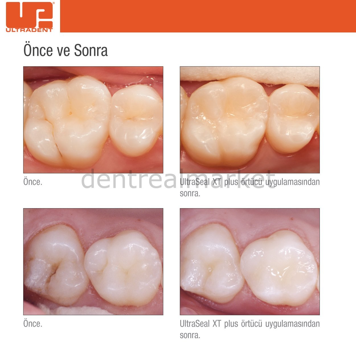 UltraSeal XT Plus Pit ve Fissür Örtücü Kit | Ultradent